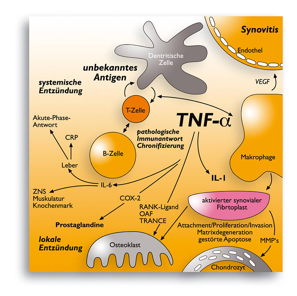 Rheumatoide Arthritis / chronische Polyarthritis – rheuma-online