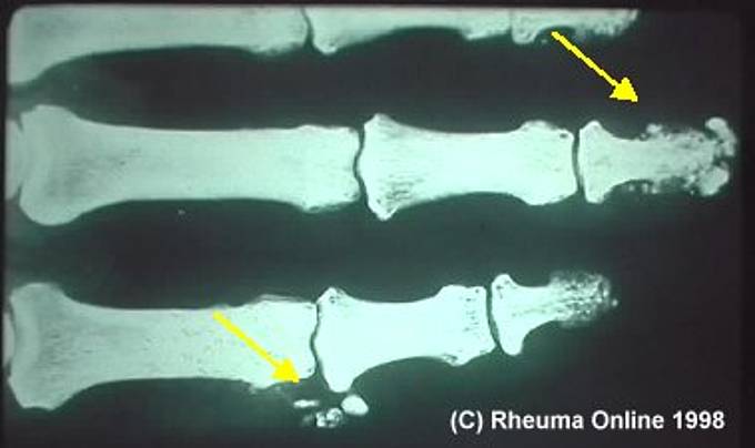 Calcinosis cutis – rheuma-online