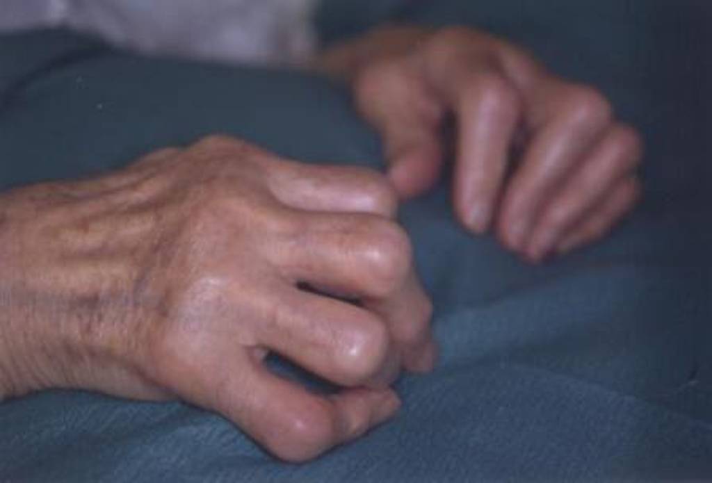 Rheumatoide Arthritis / chronische Polyarthritis – rheuma-online