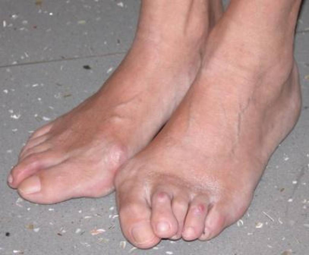 Rheumatoide Arthritis / chronische Polyarthritis – rheuma-online