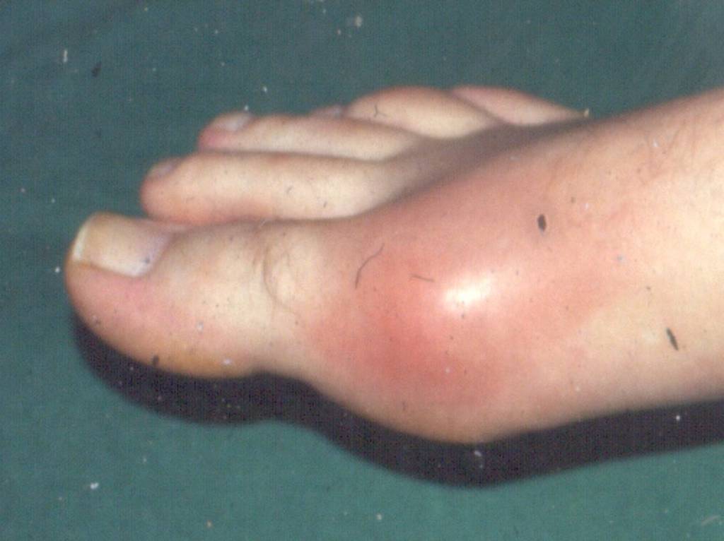 Gicht – rheuma-online